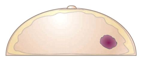 How To Find An Isoechoic Lesion With Breast Us Radiographics