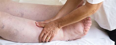 Lymphedema Treatment