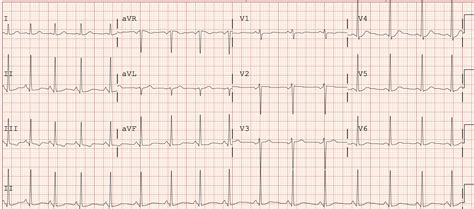 Ecg Post Syncope Rreadmyecg