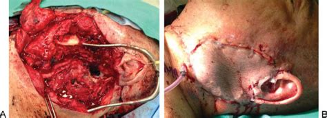 A Lateral Skull Base Defect Following The Excision Of A Parotid