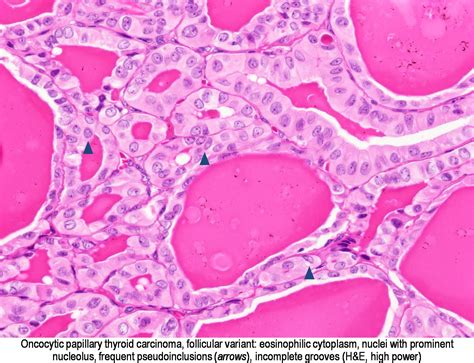 Pathology Outlines Follicular