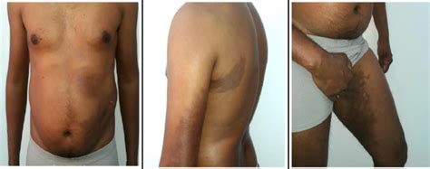 Linear Atrophoderma Of Moulin A Case Report Pmc