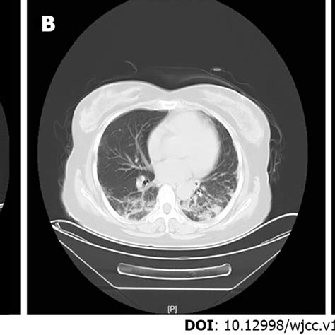 Chest Computed Tomography Scan A Diffuse Bilateral Ground Glass Download Scientific Diagram