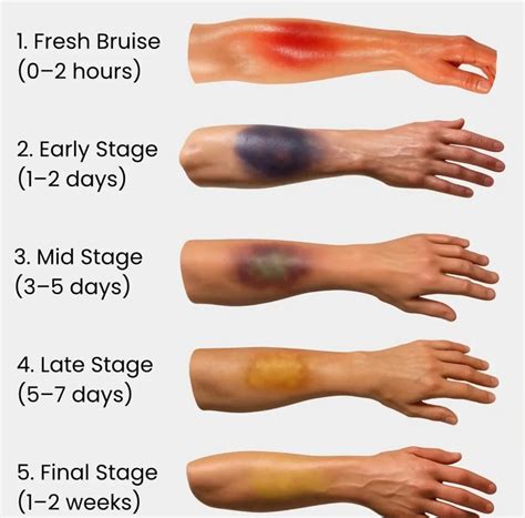 Human Anatomy Group The Evolution Of A Bruise What Those Colours