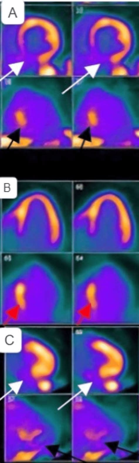 Petct Myocardial Perfusion Scan Showing A Severe Perfusion Defect In