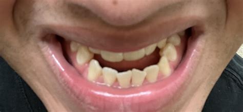 Can I Fix My Underbite Without Surgery Rteethcare