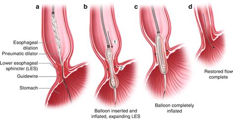 Endoscopic Variceal Banding Ligation At Arthur Ritchie Blog