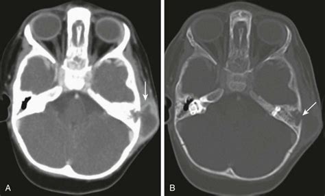 Infection And Inflammation Radiology Key