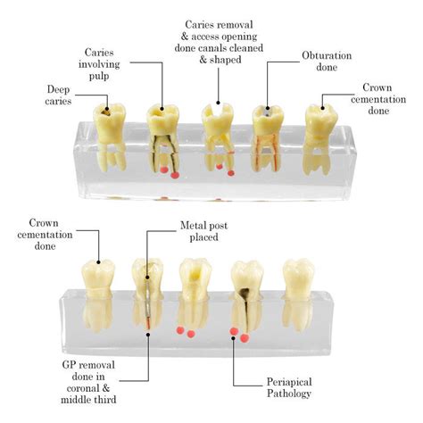 Identical Root Canal Model M4012