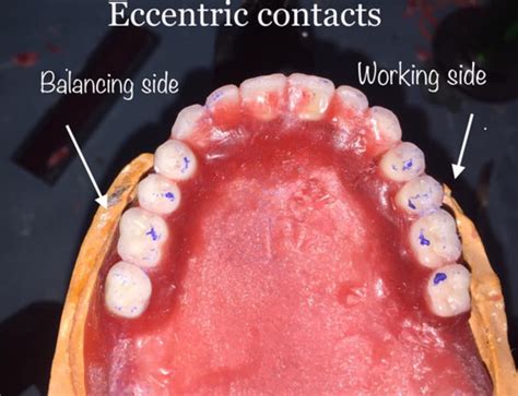 Fixed Prosthodontics Flashcards Quizlet