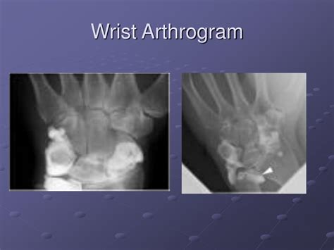 Ppt Arthrography Powerpoint Presentation Free Download Id906590