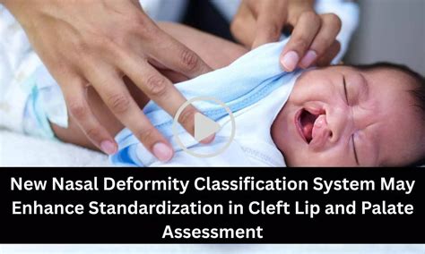 New Nasal Deformity Classification System May Enhance Standardization In Cleft Lip And Palate