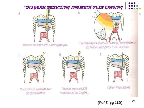 Direct Pulp Capping Vs Pulpotomy At Steve Nadeau Blog
