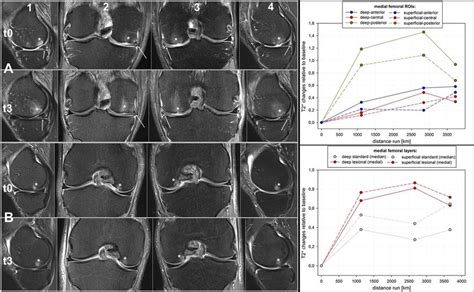 Osteochondral Lesions In The Ftj At Baseline T0 And Last Mi T3