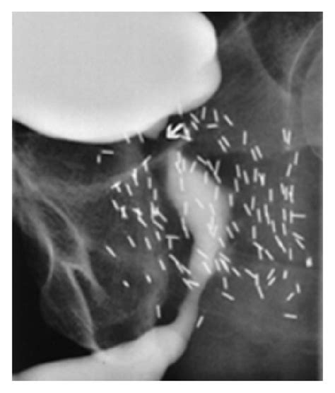 Bulbar And Bladder Neck Stricture From Combined Ebrt And Brachytherapy Download Scientific