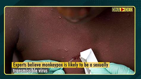 Monkeypox Who Warns Virus Spreading In Sexual Networks Can The Virus