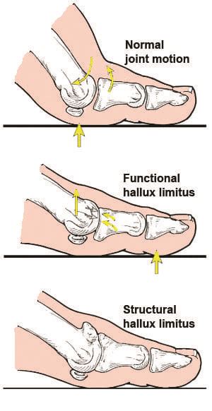 Understanding Functional Hallux Limitus Ep Wellness And Functional
