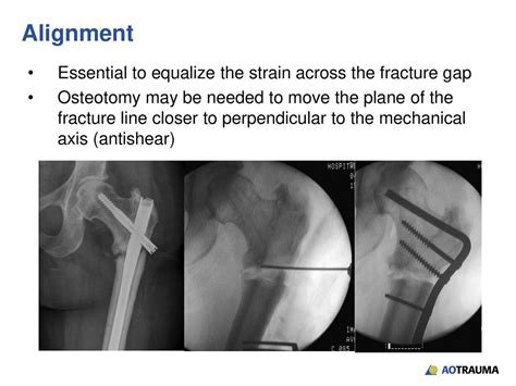 Fracture Gap Strain At Rosa Vega Blog