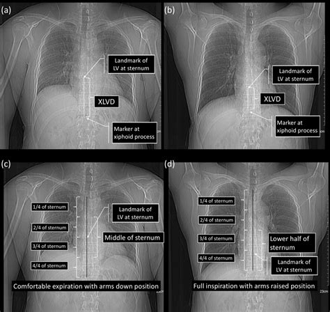 Xiphoid Process Of Sternum Xiphoid Process Of Sternum