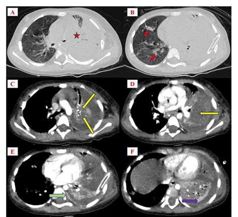 Figure 1 From A Complex Case Of Necrotizing Pneumonia And Parapneumonic