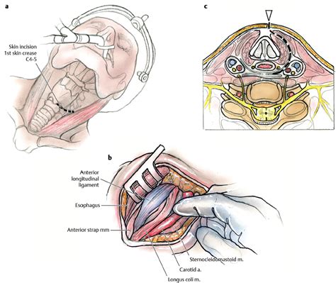 Cervical Arthroplasty Neupsy Key