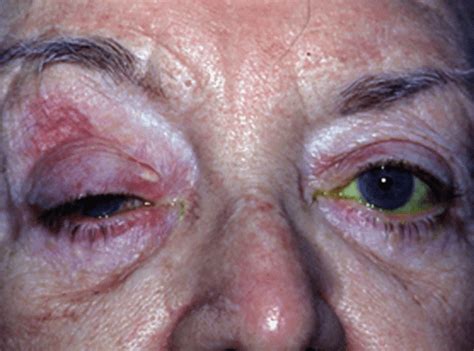 Blepharoptosis Aponeurotic Involutional Ento Key