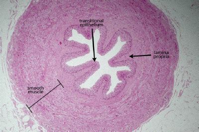 Lamina De Ureter Ureteric Injury Radiology Reference Article