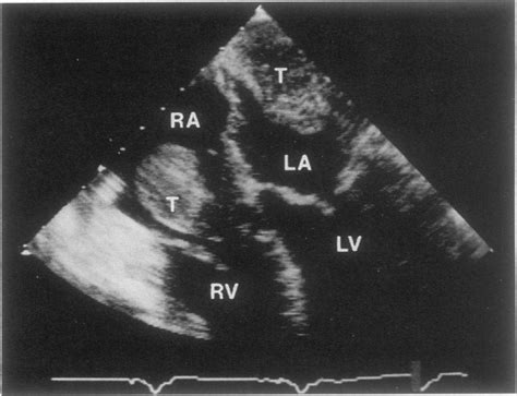 Transesophageal Echocardiogram In The 4 Chamber View Horizontal Plane Download Scientific