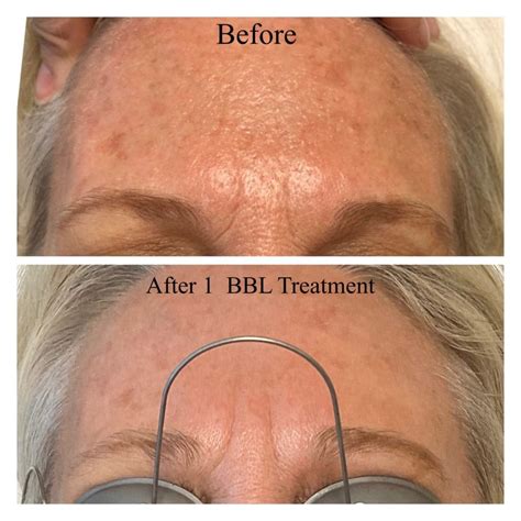 Sciton Bbl Laser Dermatology Care Of Charlotte