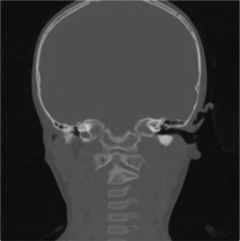 Ossicular Deformity In The Right Ear Download Scientific Diagram