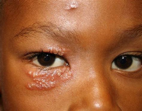 Facial Shingles Information You Need To Know Vinmec