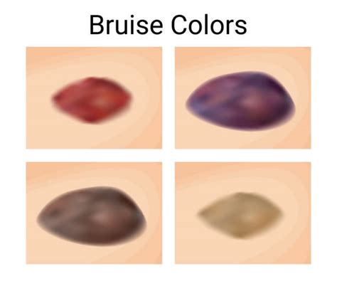 90 Purple Bruise Stock Illustrations Royalty Free Vector Graphics
