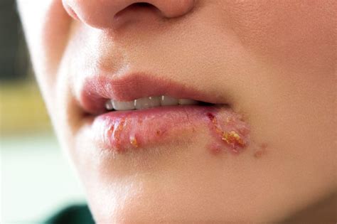 Chlamydia Vs Gonorrhea Vs Trichomoniasis Key Differences Explained