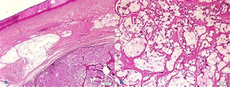 A The Dermal Tumor Had A Cribriform Pattern Hande Â20 B Thin