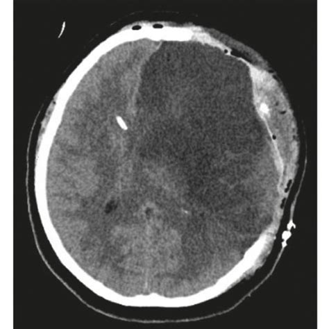 A Ct Scan Head Wo Contrast A Large Hypodensity Of The Left Mca Download Scientific Diagram
