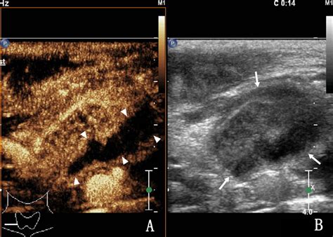 A 31 Year Old Woman With Right Cervical Lymph Node Tuberculous A Ceus
