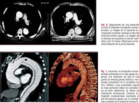 Figure 7 From Avances En El Síndrome Aórtico Agudo Semantic Scholar