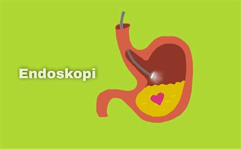 Endoskopi Puasa Berapa Jam At Sophie Denny Blog