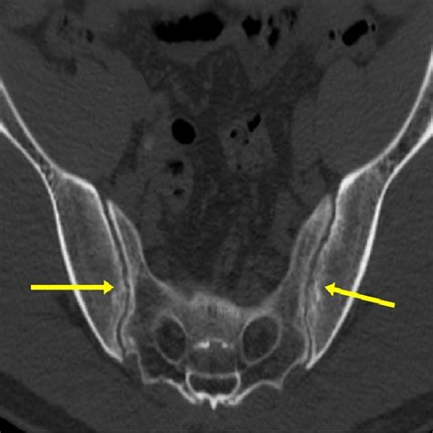 Ankylosing Spondylitis Of L Spine Lateral Radiograph Of L Spine Shows