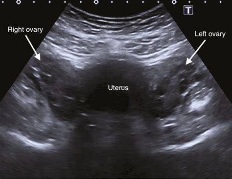 Pelvic Ultrasound Of Uterus