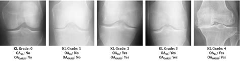논문 리뷰 An Ai System For Continuous Knee Osteoarthritis Severity