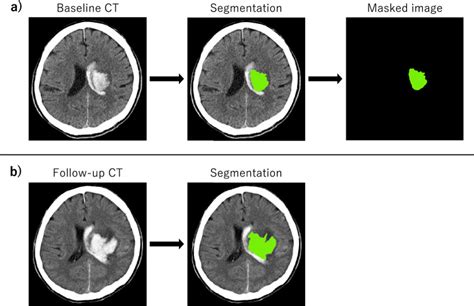 Prediction Of Hematoma Expansion In Spontaneous Intracerebral Hemorrhage Using A Multimodal