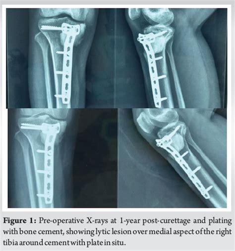 Rare Coexistence Giant Cell Tumor Recurrence And Infection In The