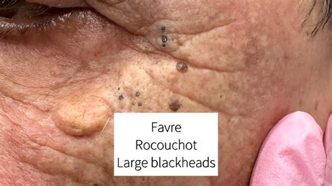 Large Blackhead Extraction Youtube