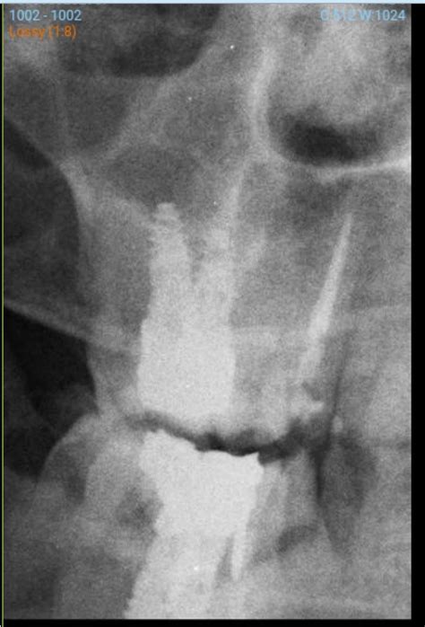 Does Right Maxilary Sinusitis Come From Teeth Infection Raskdentists