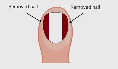 Ingrown Toenails Removal And Infected Toenails Treatment Nail Surgery Clinic London