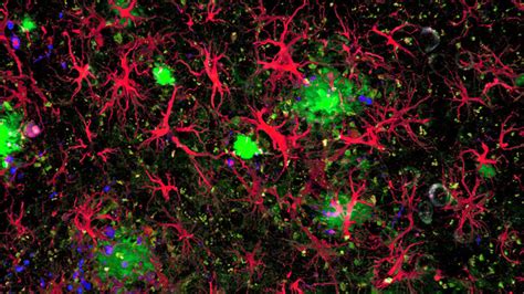 New Study Will Put The Leading Theory About Alzheimers To The Test