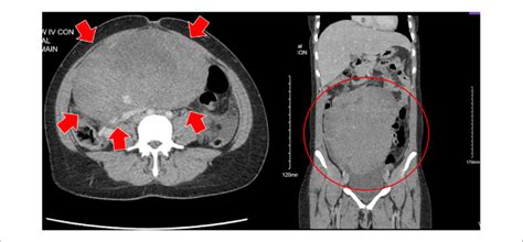 Computed Tomography Ct Of The Abdomen And Pelvis Revealing Solid Download Scientific Diagram