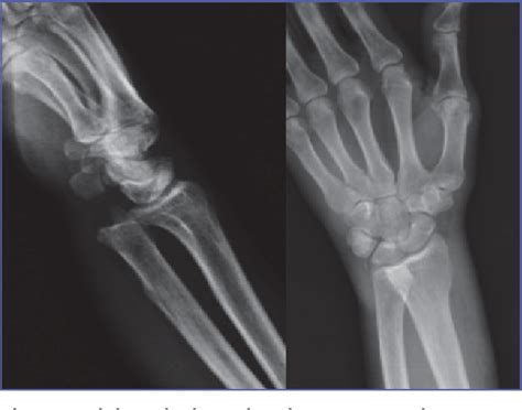 Figure 1 From Isolated Volar Ulnar Dislocation Case Report And