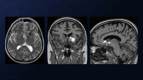341 Anterior Interhemispheric Contralateral Transcallosal Approach For Resection Of A Caudate